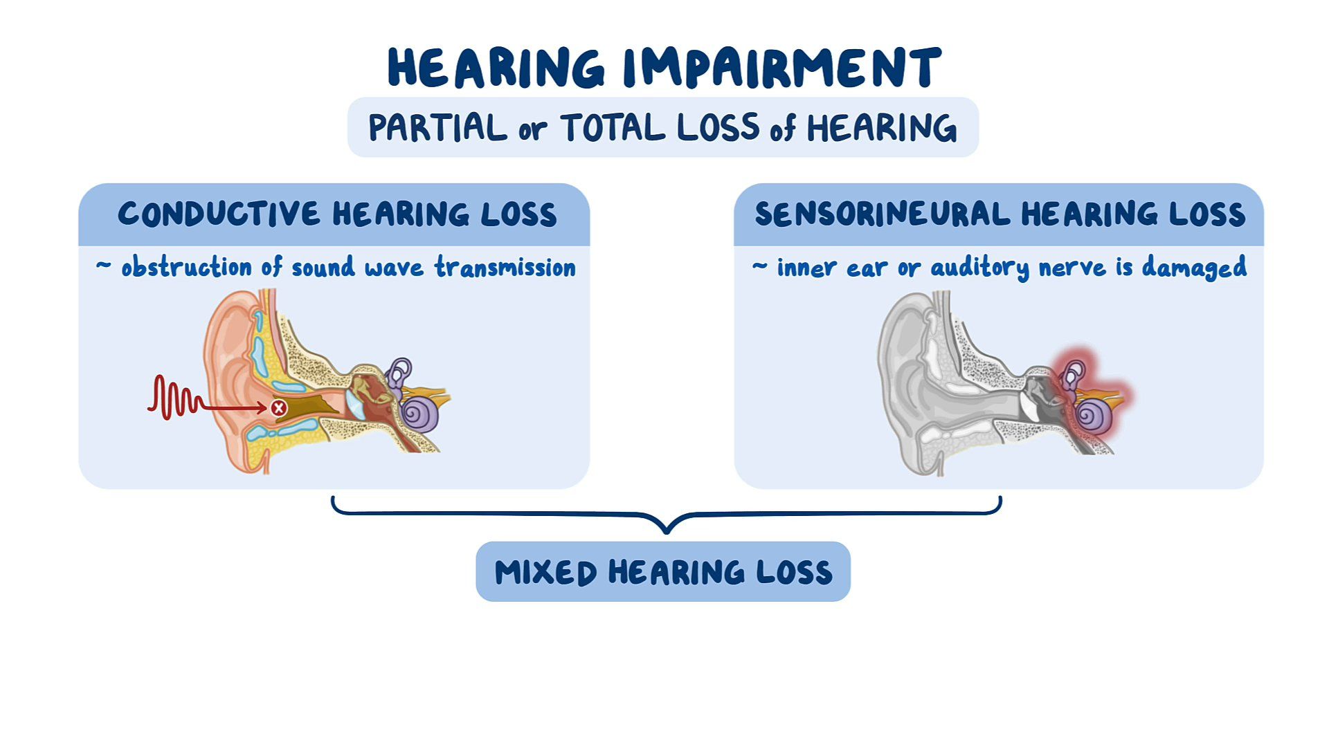 Otosclerosis Hearing Loss