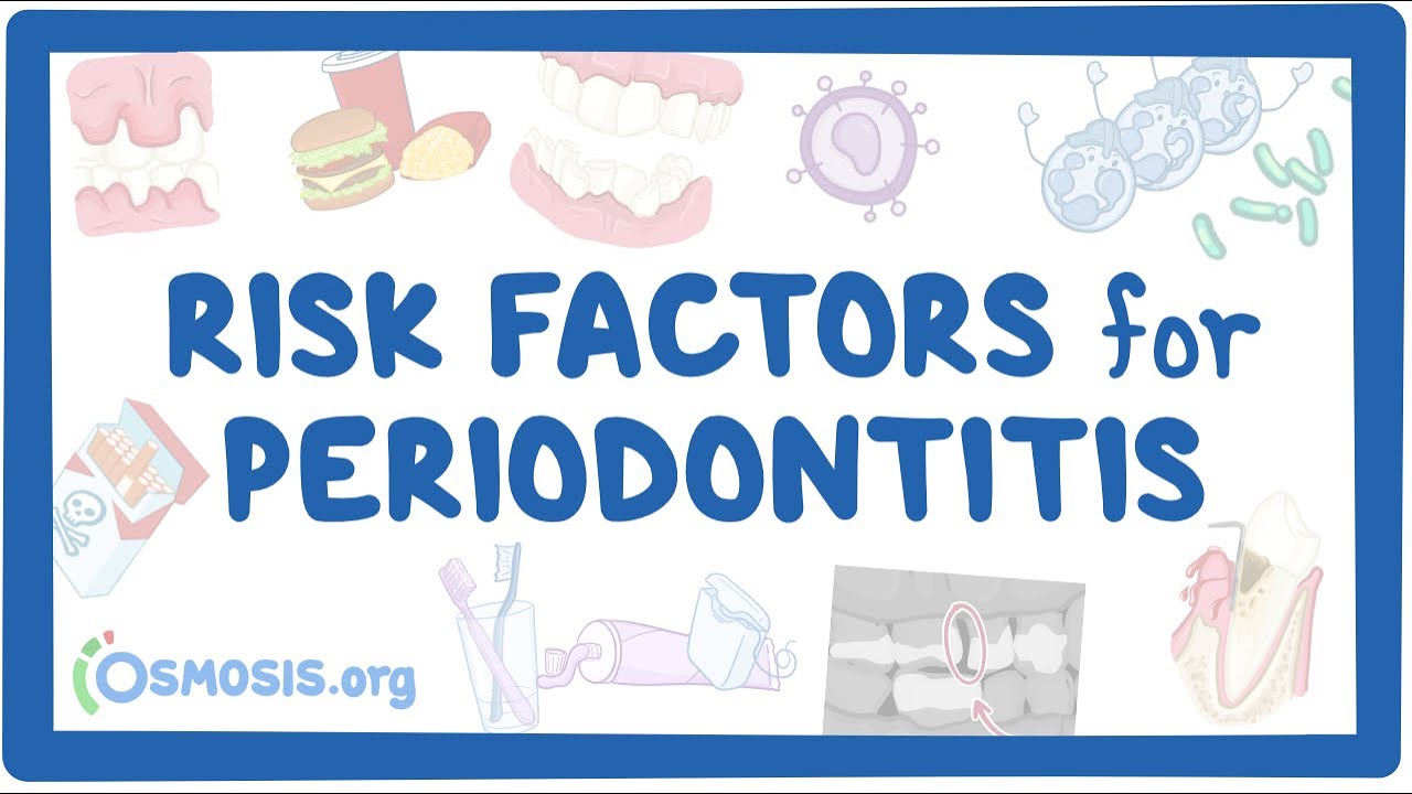 Risk factors for periodontitis: Video, Causes, & Meaning | Osmosis