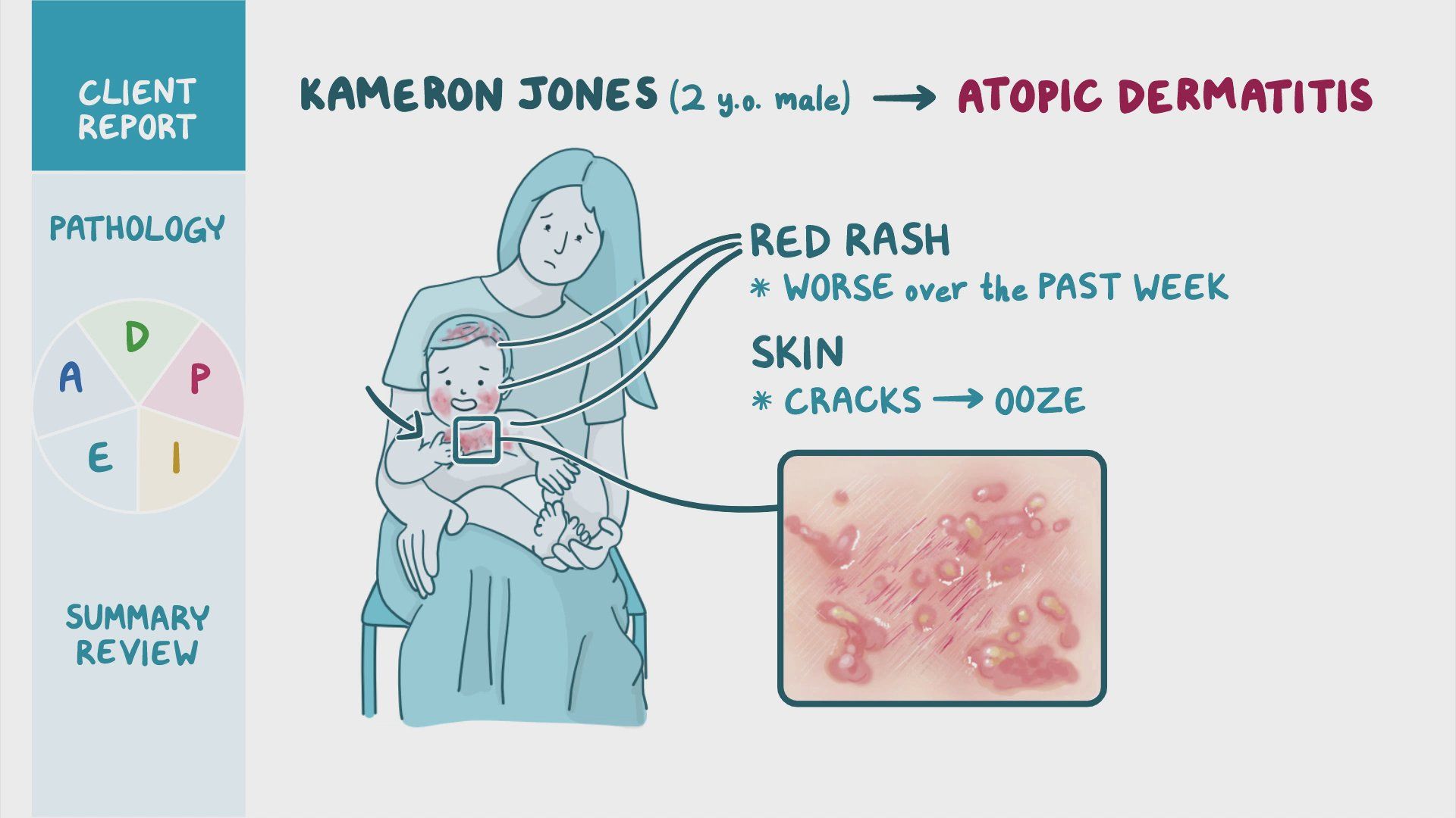 Atopic dermatitis: Nursing Process (ADPIE) - Osmosis Video Library