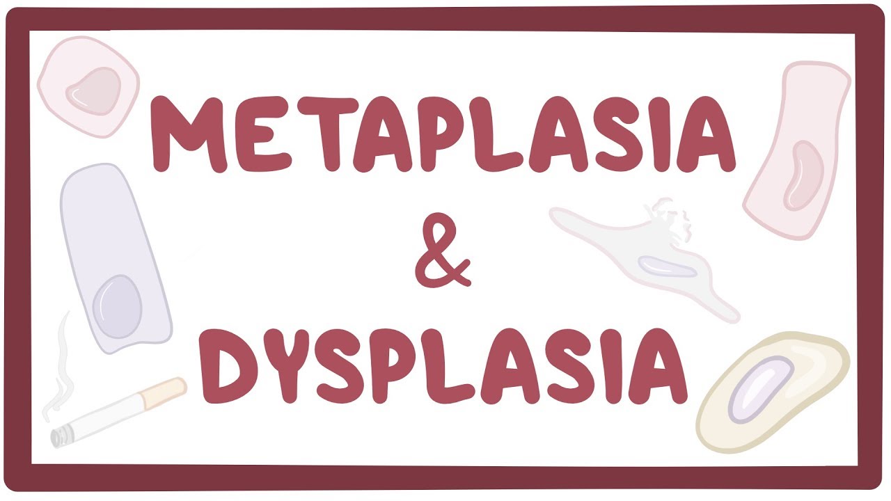 Metaplasia and dysplasia - Osmosis Video Library