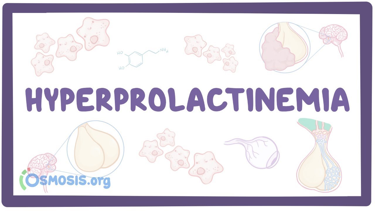 Hyperprolactinemia: Vídeo, Anatomía & Definición | Osmosis