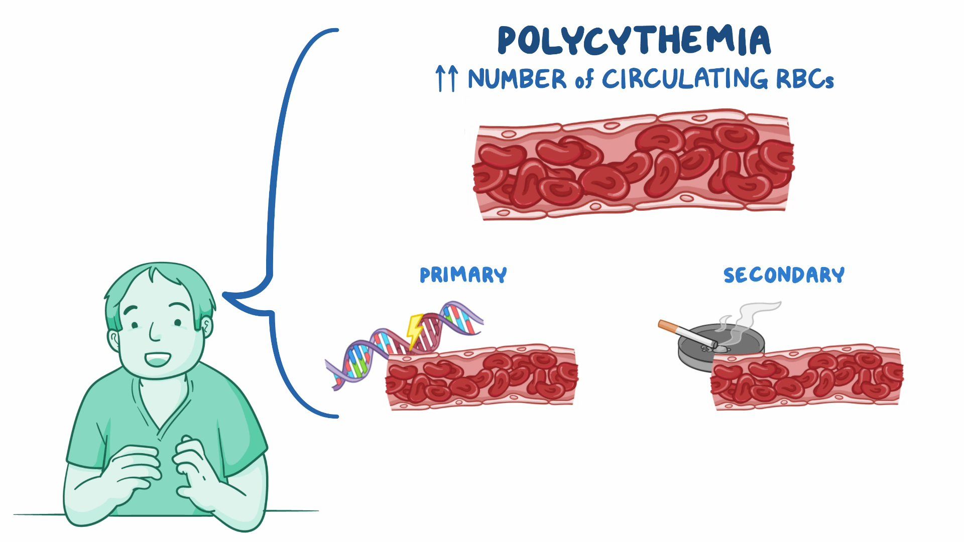 Polycythemia What Is It How It Differs From Polycythemia 58 OFF Polycythemia What Is It How It Differs From Polycythemia 58 OFF