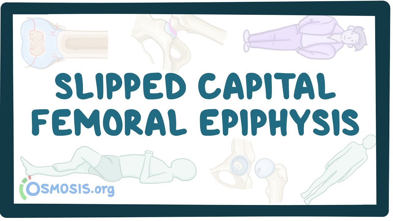 Slipped capital femoral epiphysis - Osmosis