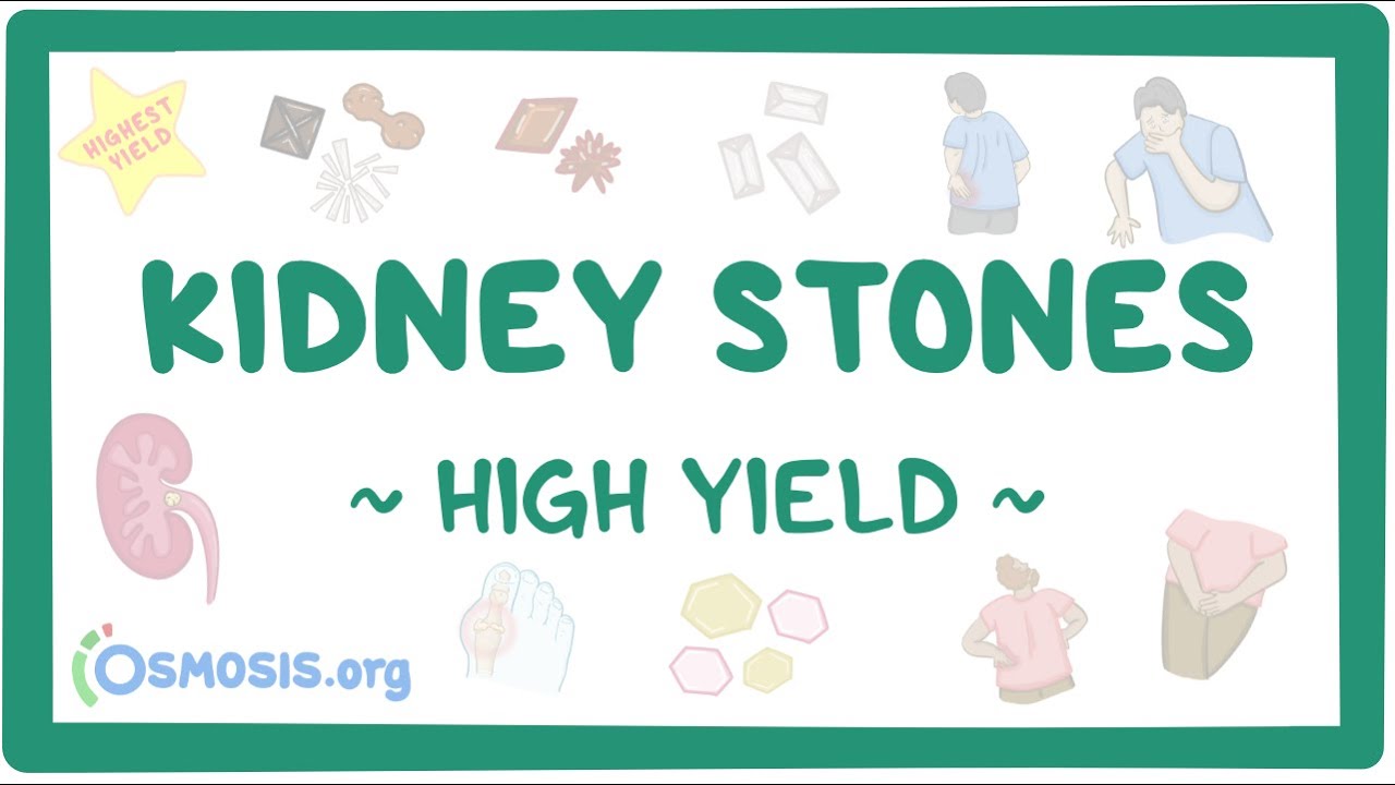 Kidney stones: Pathology review: Video, Causes, & Meaning | Osmosis