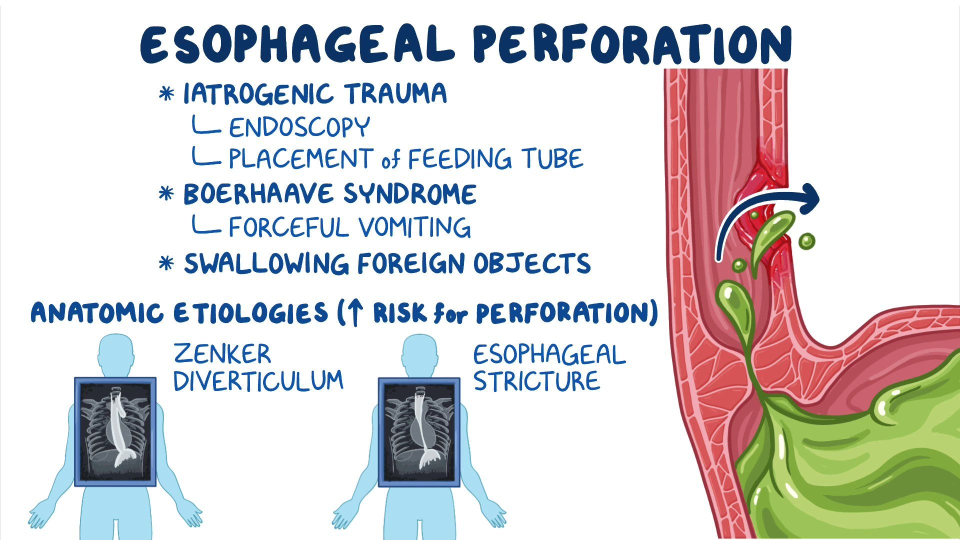 Esophagus Spasms