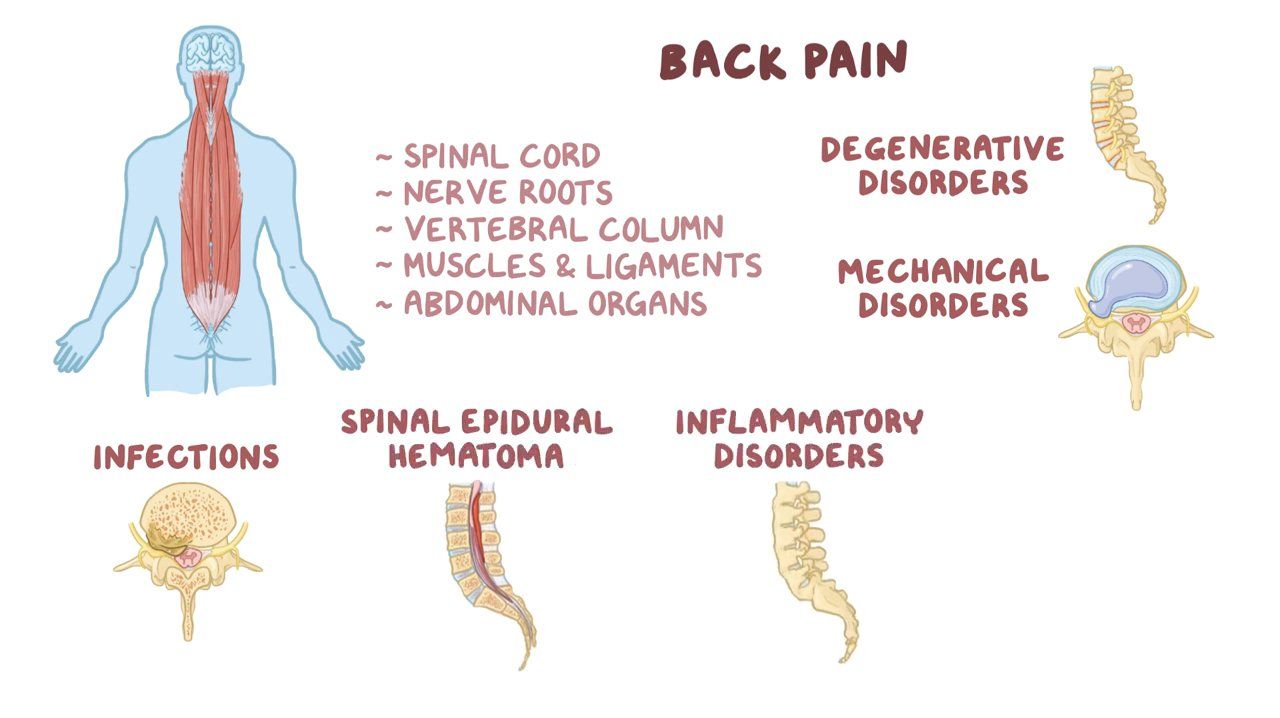 Lower Back Pain Clinical Video Anatomy Definition Osmosis