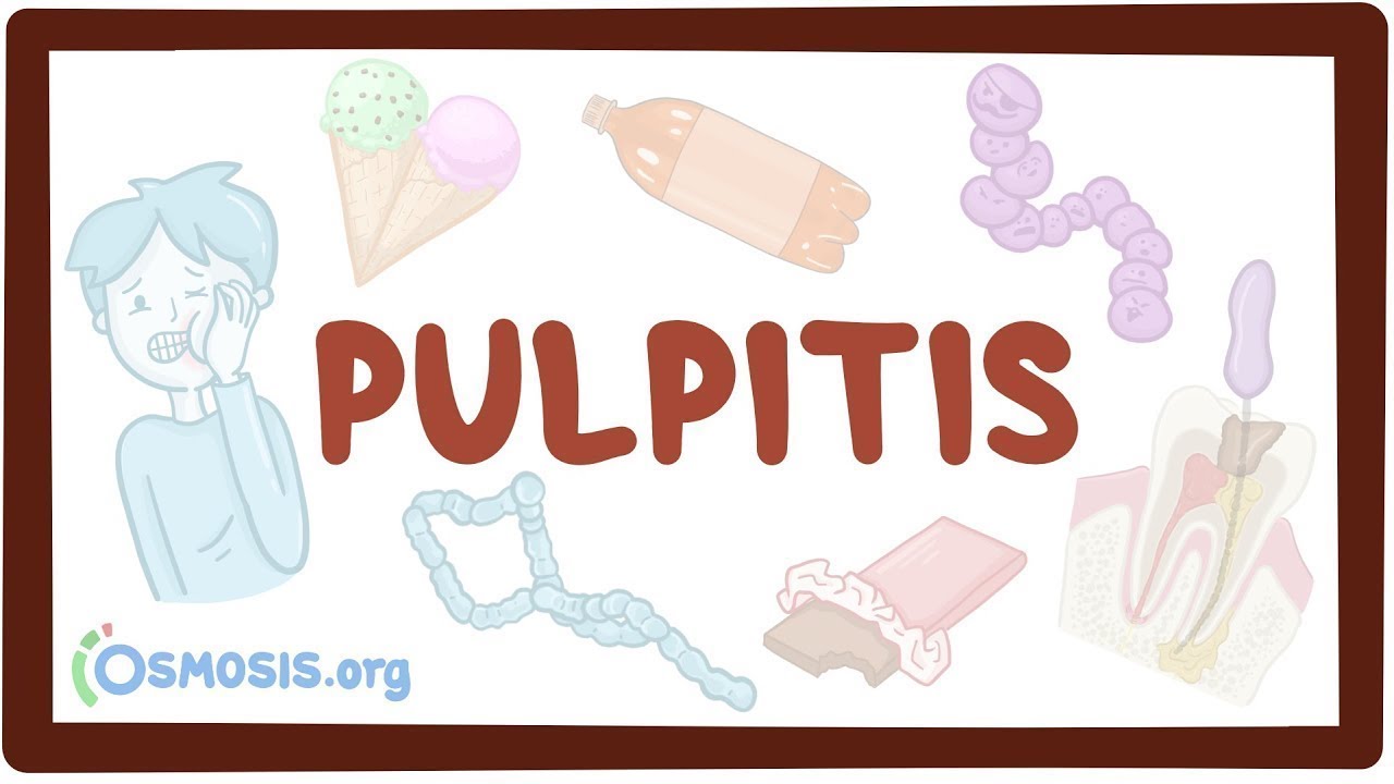 Pulpitis: Video, Causes, & Meaning | Osmosis