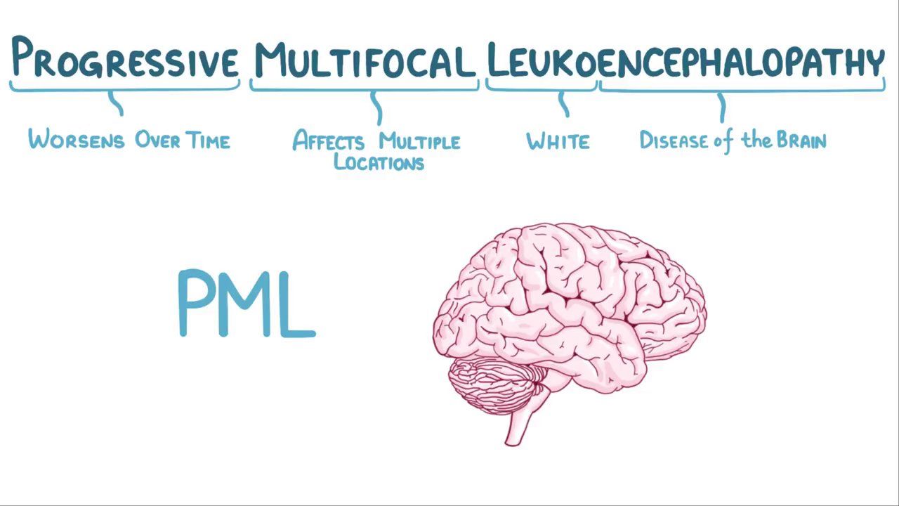 JC Virus Progressive Multifocal Leukoencephalopathy Osmosis JC Virus Progressive Multifocal Leukoencephalopathy Osmosis