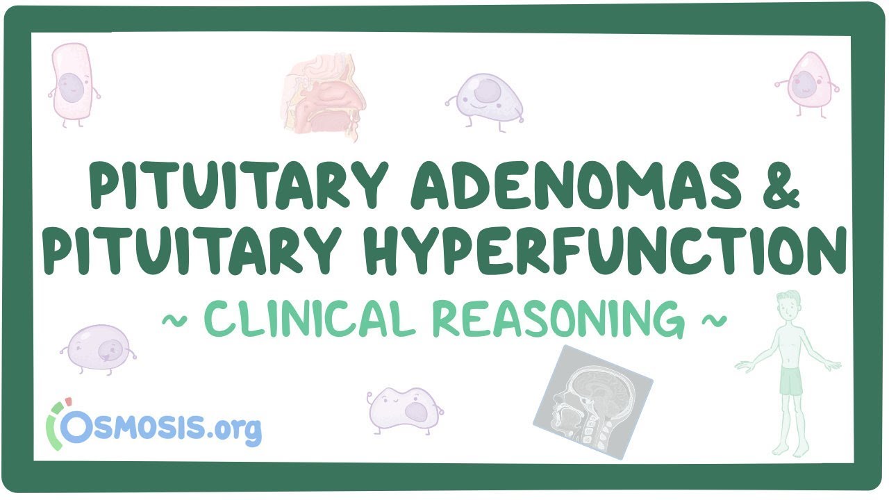 Pituitary adenomas and pituitary hyperfunction: Clinical | Osmosis