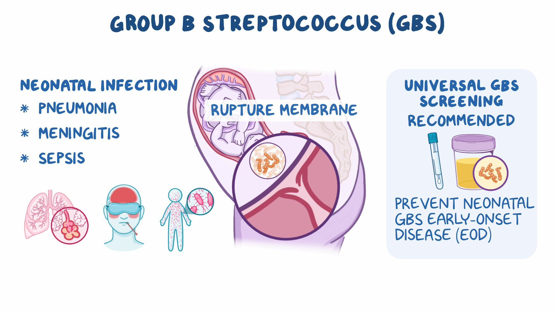 Group B Streptococcus GBS Colonization In Pregnancy Clinical
