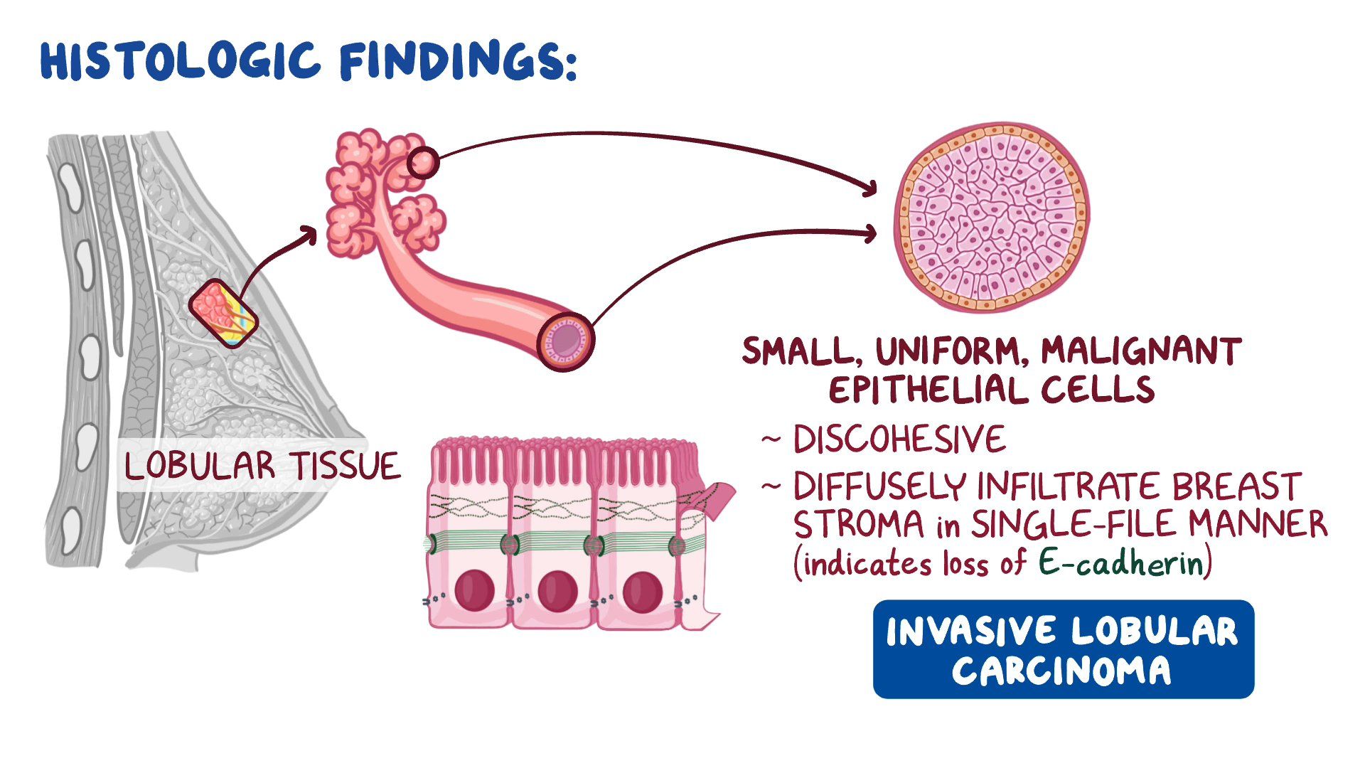 Invasive lobular carcinoma: Clinical sciences - Osmosis Video Library