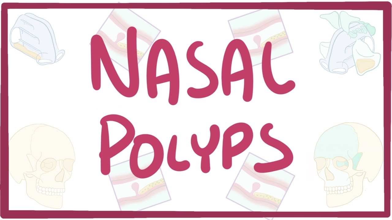 Nasal polyps: Video, Causes, & Meaning | Osmosis