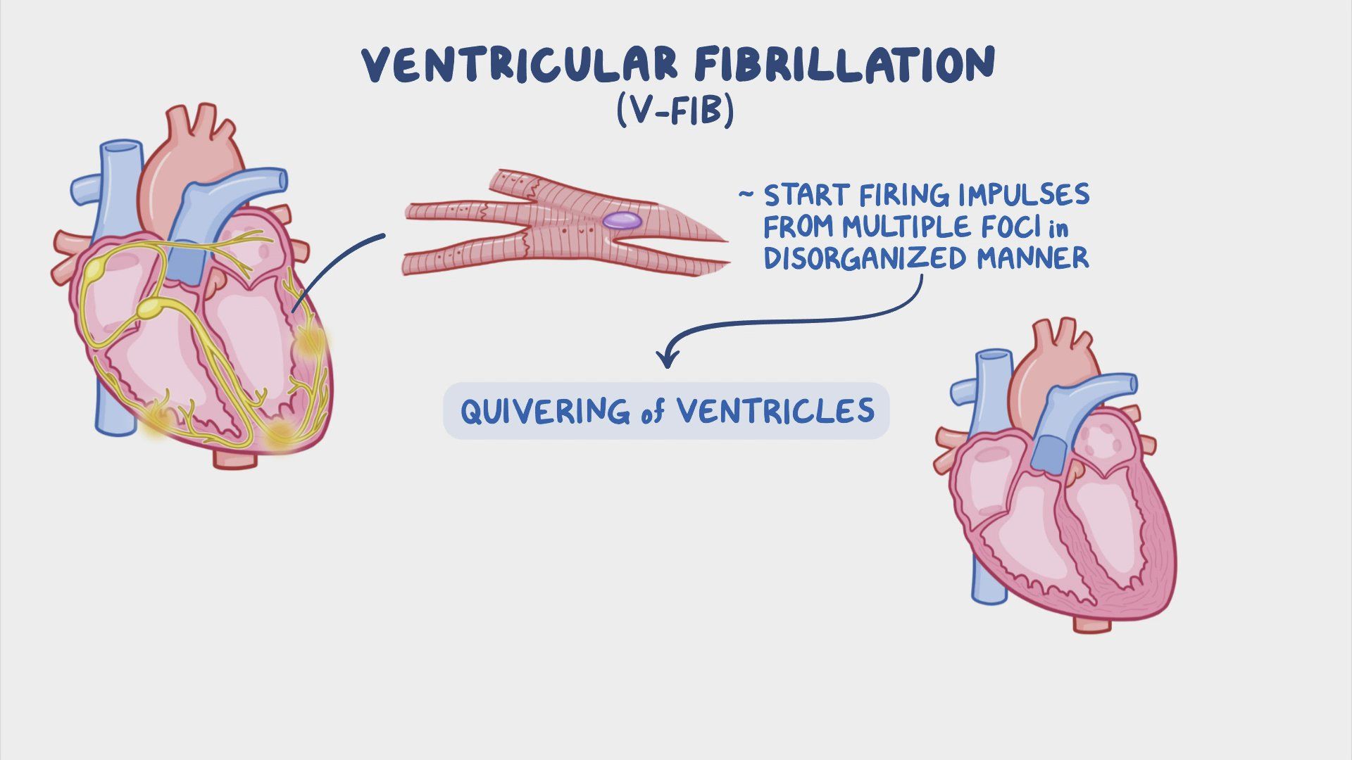 Ventricular Fibrillation Vs Atrial Fibrillation Ventricular Fibrillation Vs Atrial Fibrillation