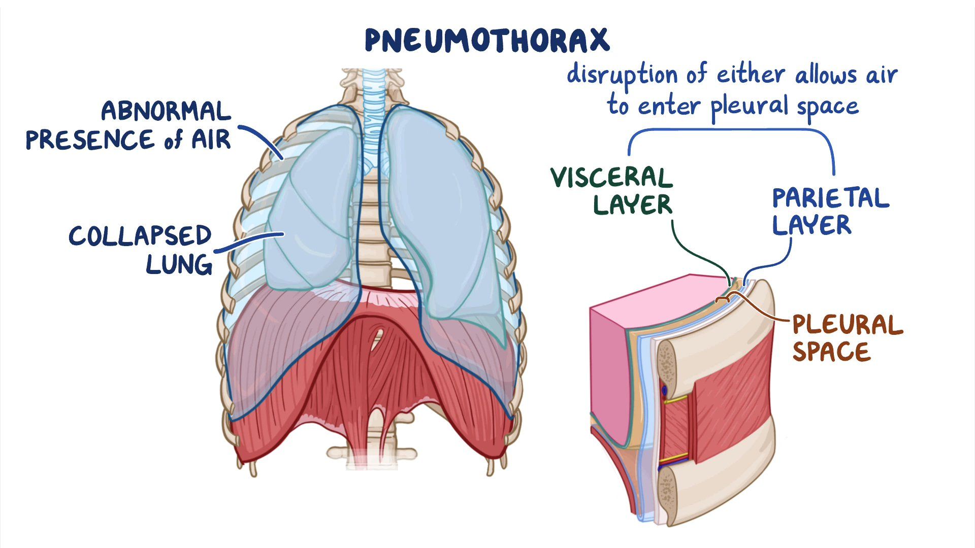 Open Pneumothorax What Is It Diagnosis And More Osmosis 51 OFF Open Pneumothorax What Is It Diagnosis And More Osmosis 51 OFF