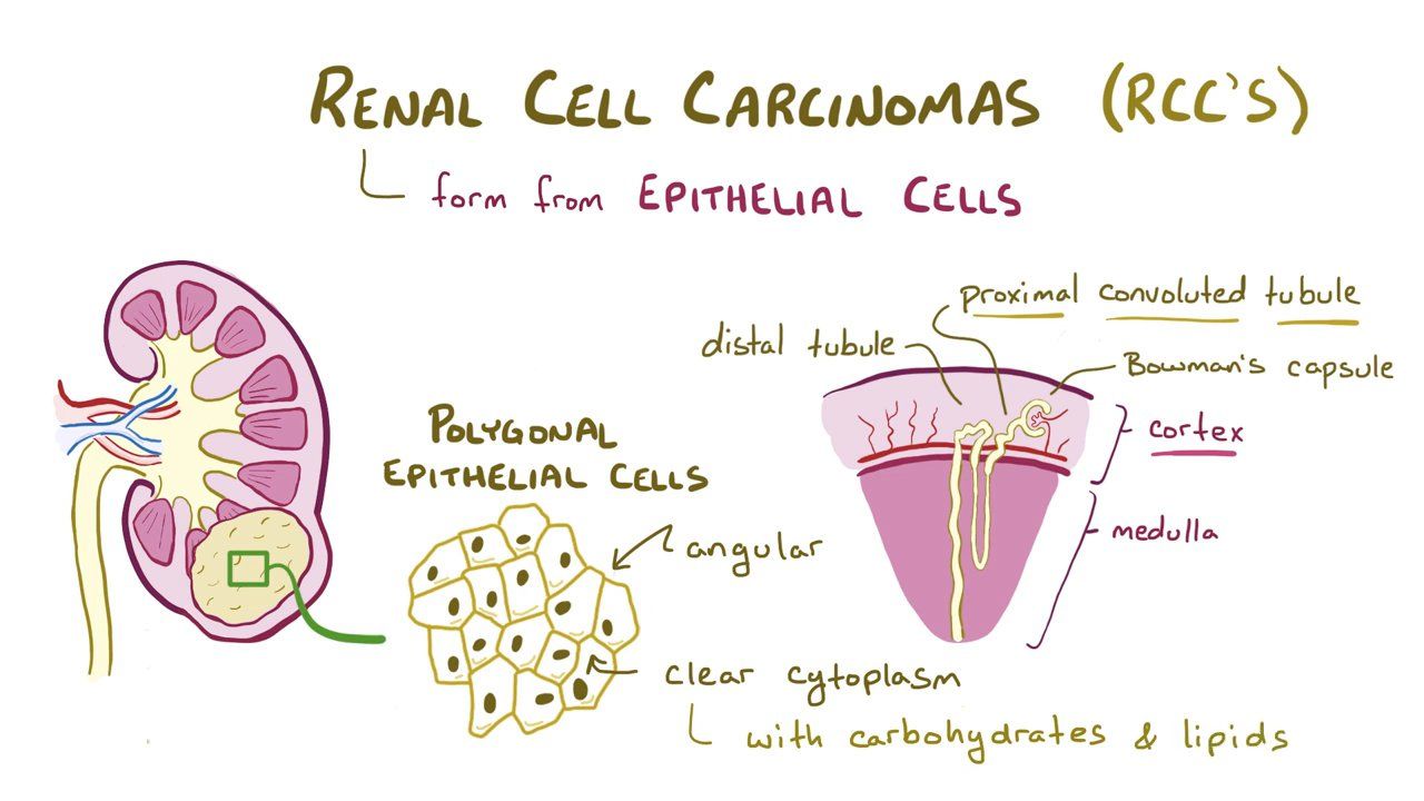 Renal Cell Carcinoma Renal Cell Carcinoma