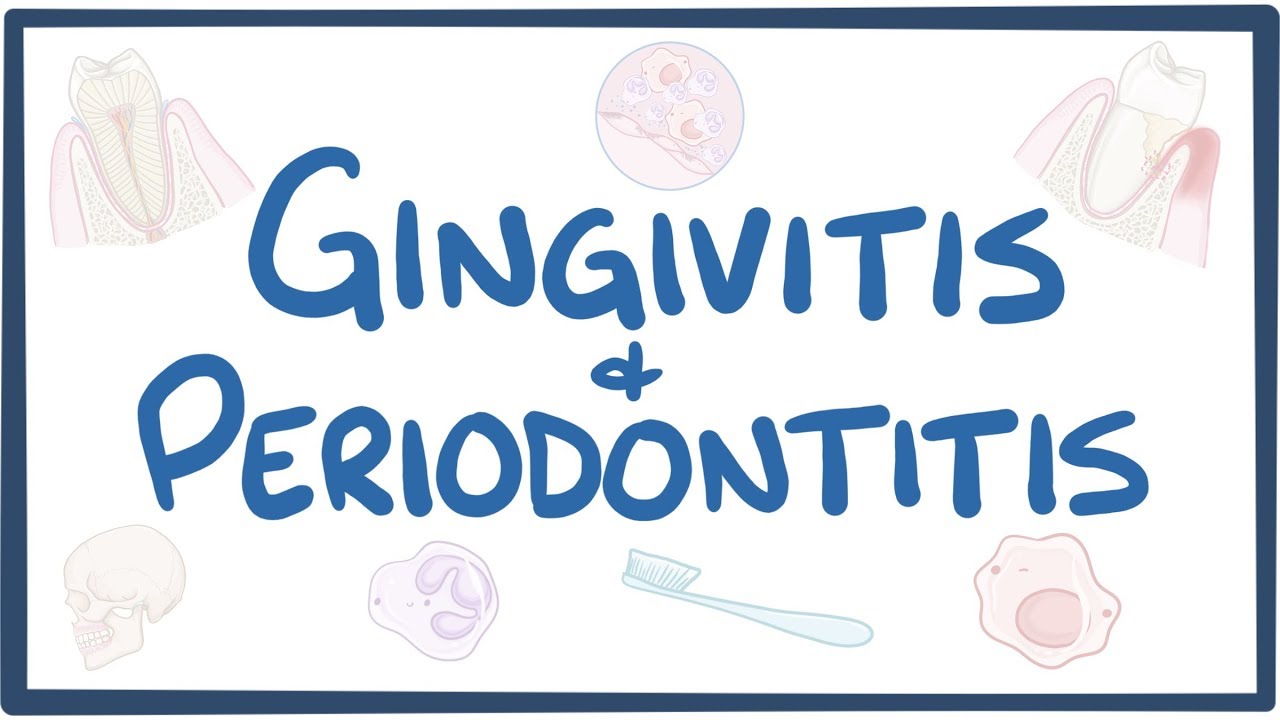Gingivitis and periodontitis: Video, Causes, & Meaning | Osmosis