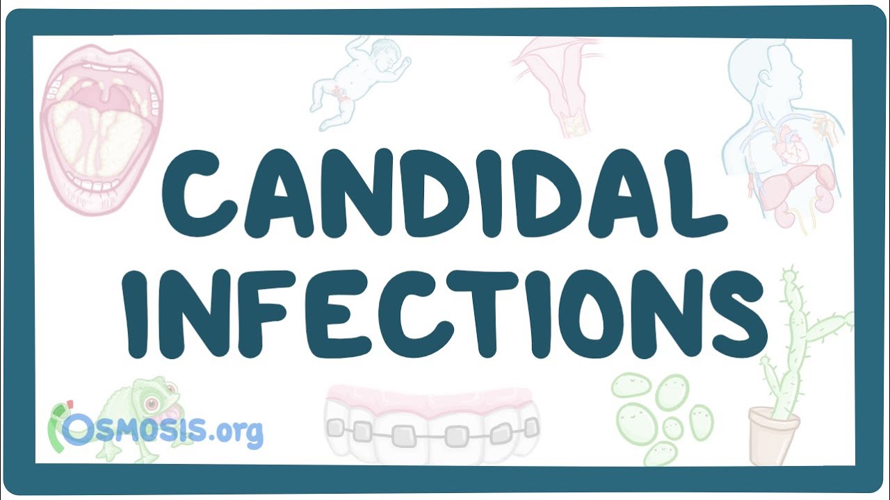 Candida: Video, Causes, & Meaning | Osmosis