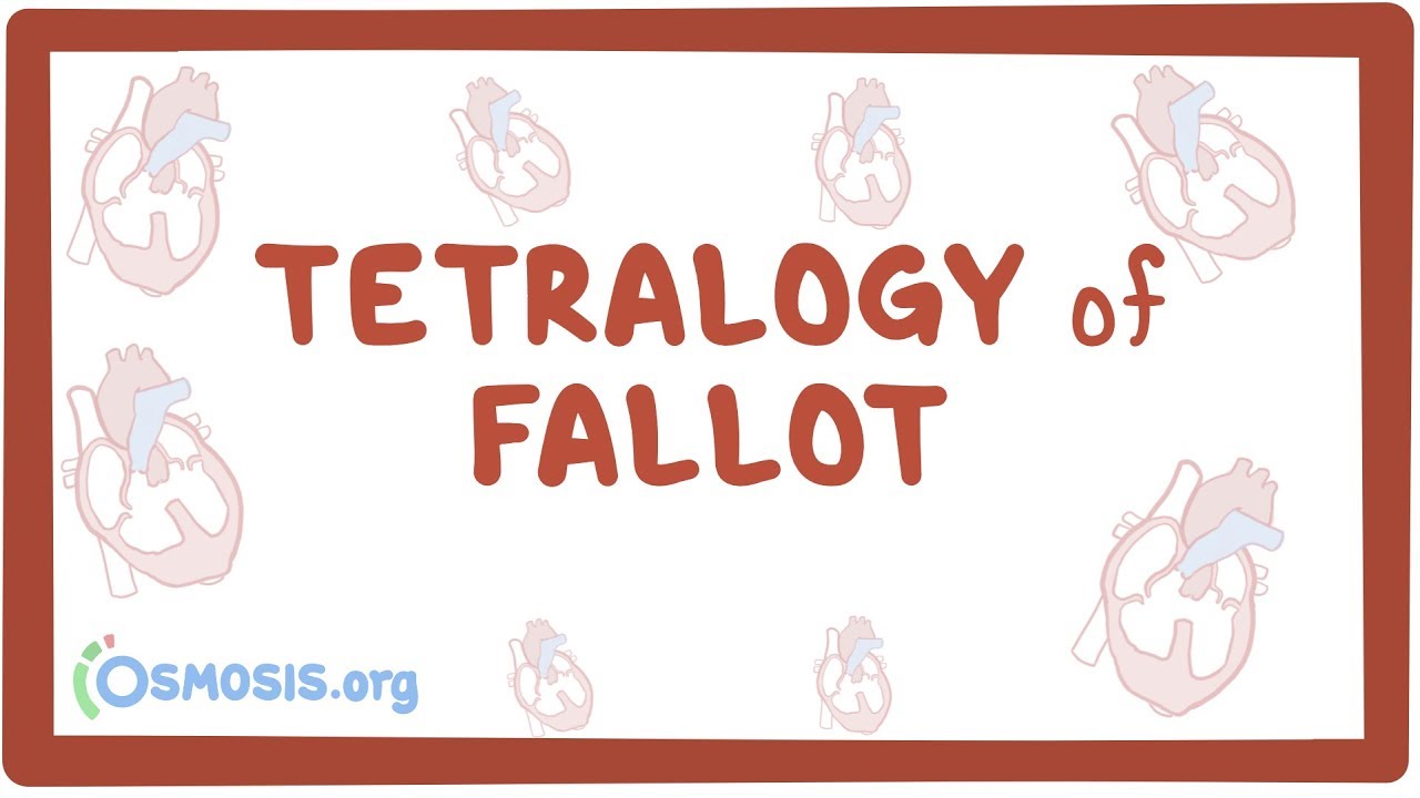 Tetralogy of Fallot | Osmosis