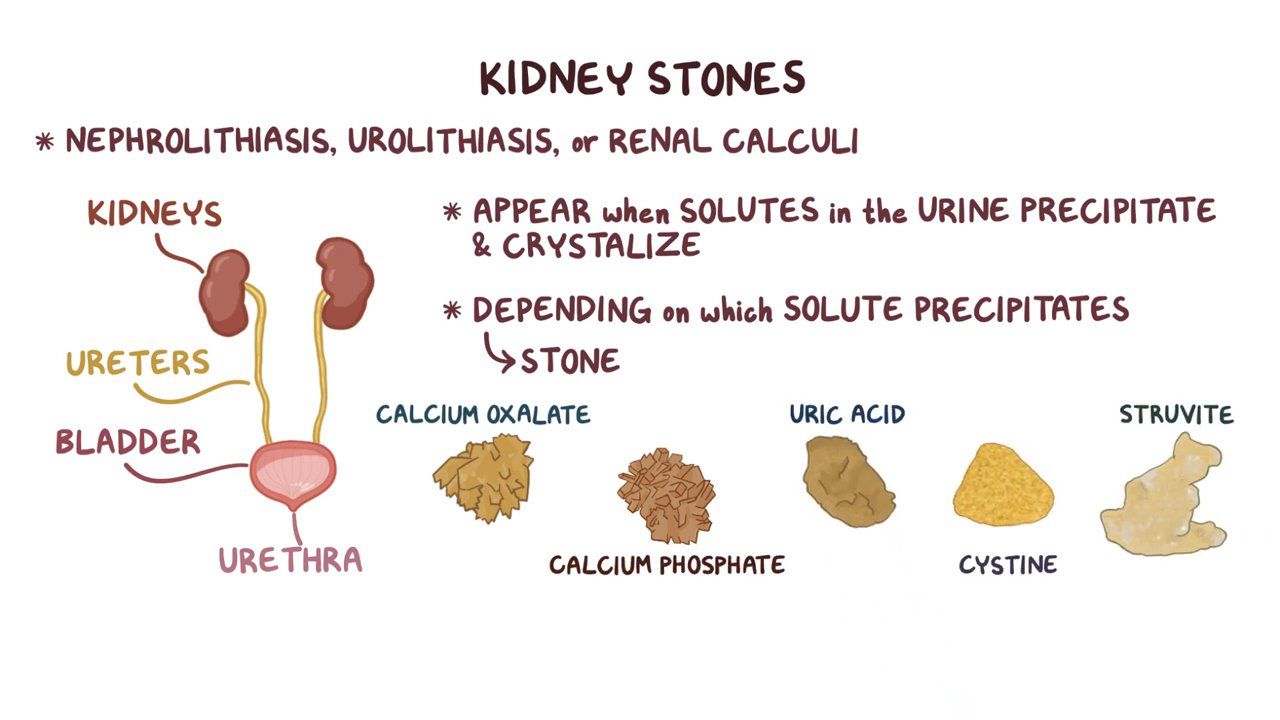 Kidney Stones Clinical Video Anatomy Definition Osmosis Kidney Stones Clinical Video Anatomy Definition Osmosis