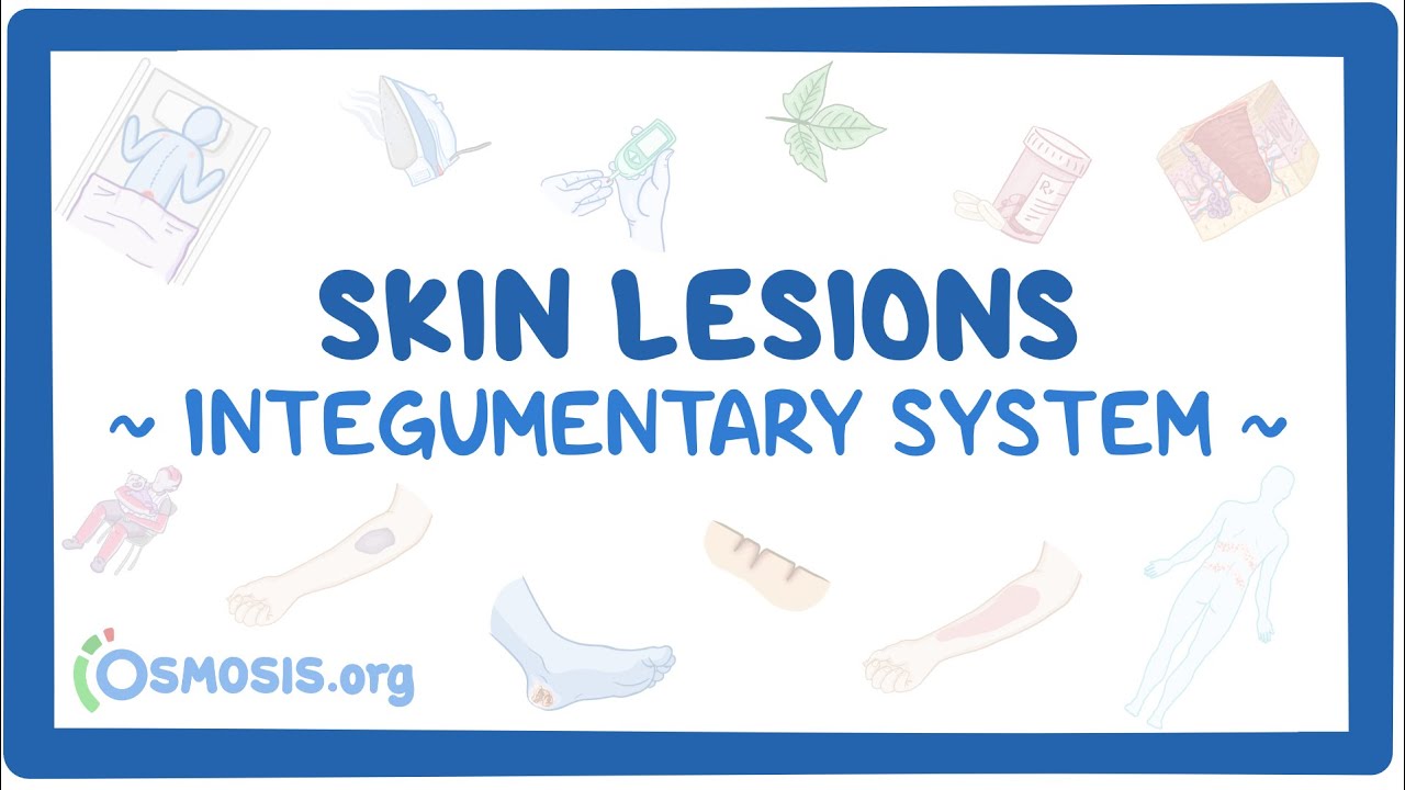 Integumentary system: Skin lesions: Video, Causes, & Meaning | Osmosis
