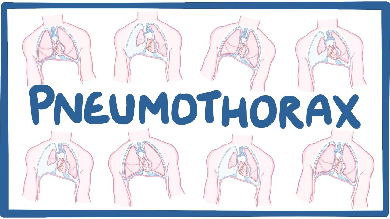 Pneumothorax: Video, Causes, & Meaning | Osmosis
