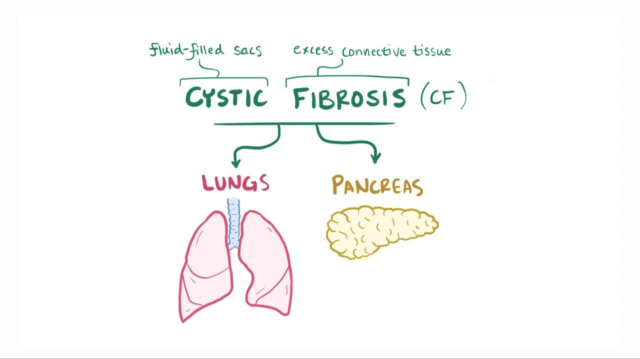 Cystic Fibrosis CF Causes Symptoms Diagnosis Treatment 60 OFF