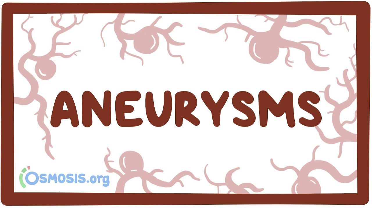 Aneurysms: Video, Causes, & Meaning | Osmosis