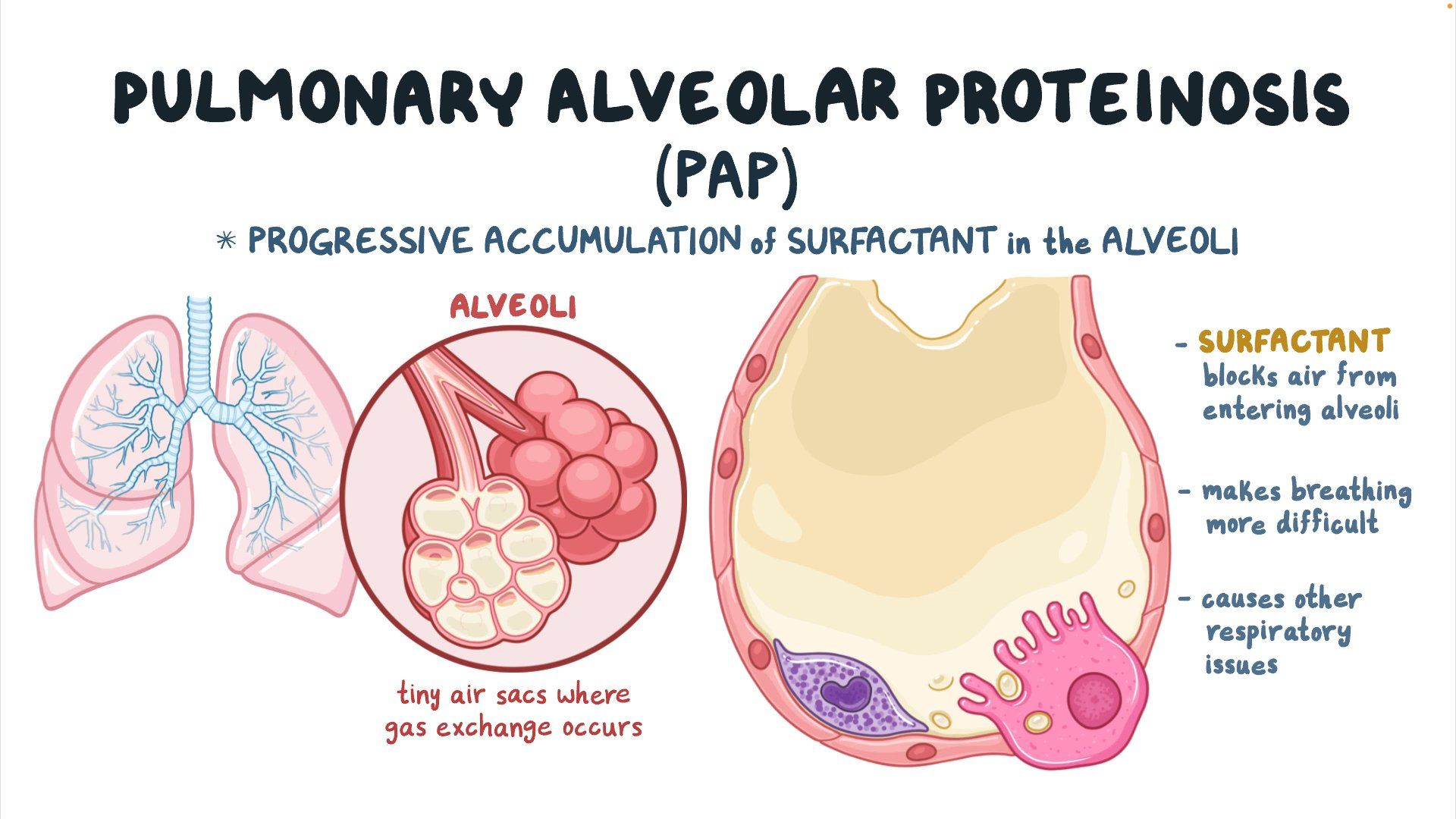 Pulmonary Alveolar Proteinosis In Adults: Pathophysiology, 58% OFF Pulmonary Alveolar Proteinosis In Adults: Pathophysiology, 58% OFF