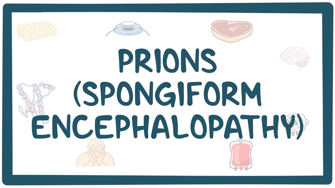Prions (Spongiform encephalopathy): Video, Causes, & Meaning | Osmosis Prions (Spongiform encephalopathy): Video, Causes, & Meaning | Osmosis