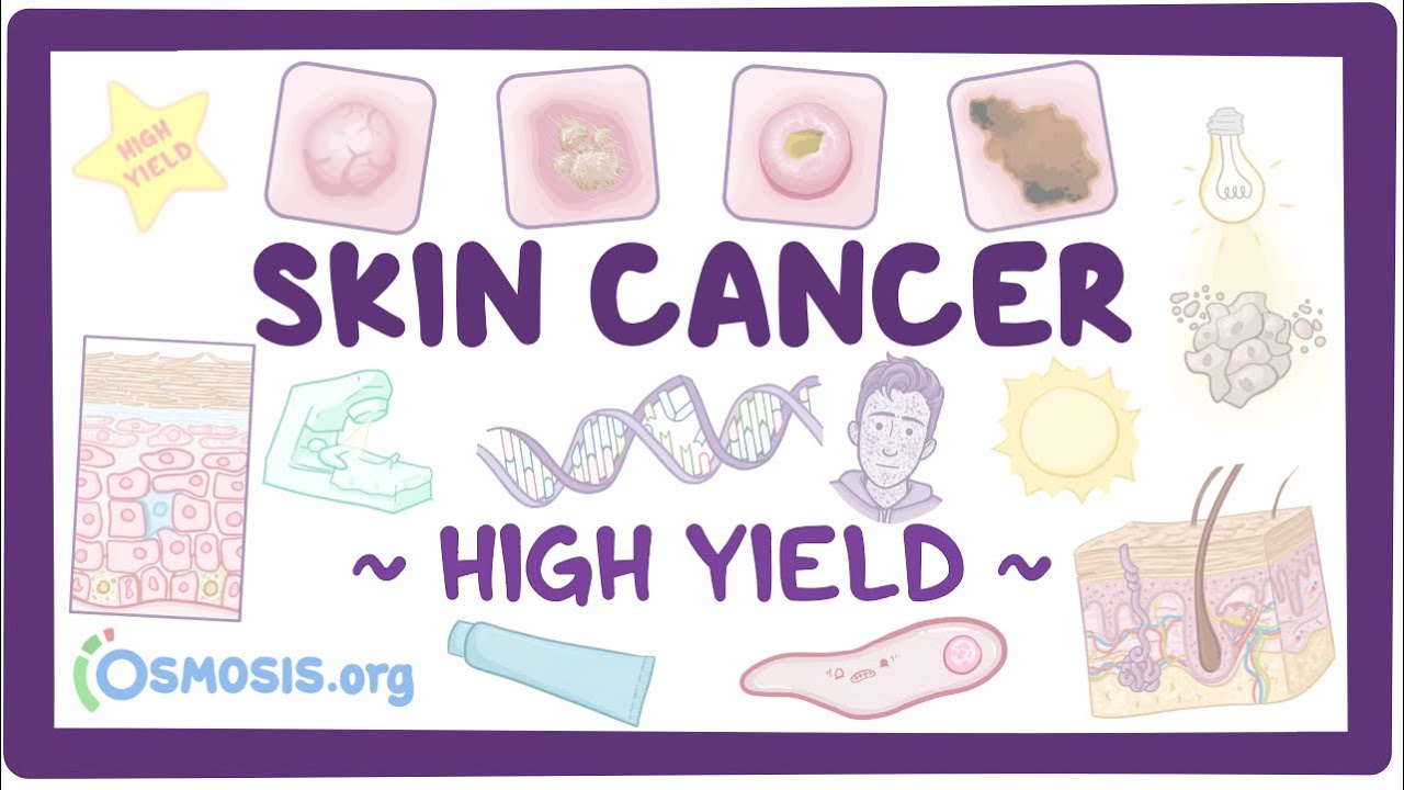Skin cancer: Pathology review: Video, Causes, & Meaning | Osmosis