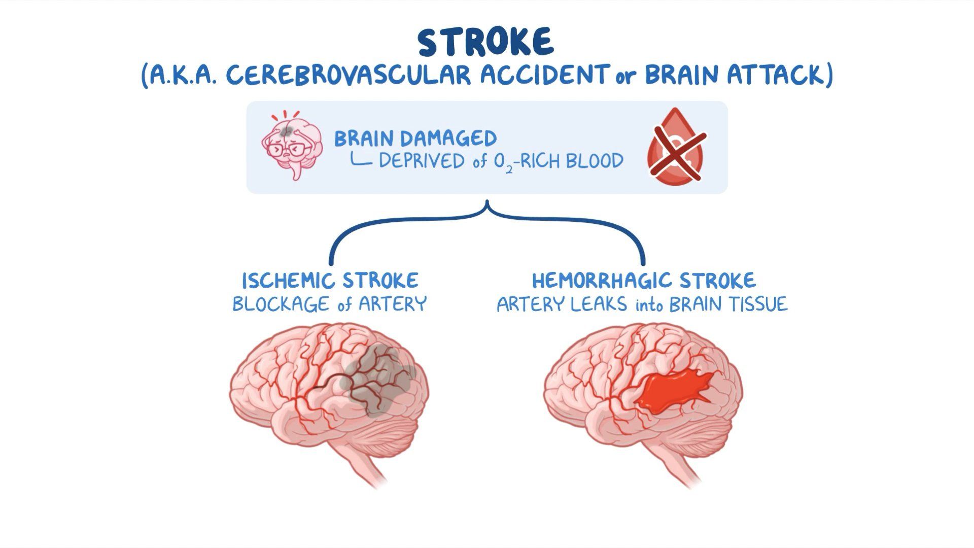 Intracranial Hypertension