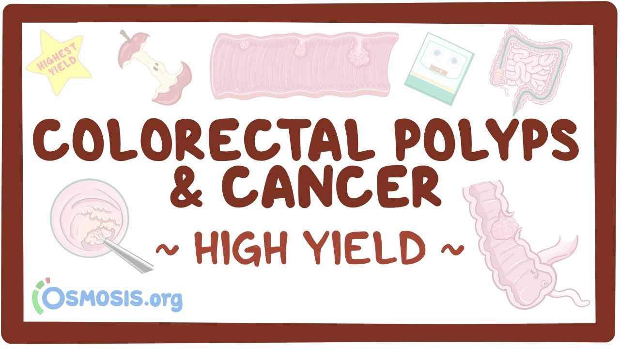 Colorectal polyps and cancer: Pathology review: Video, Causes ...
