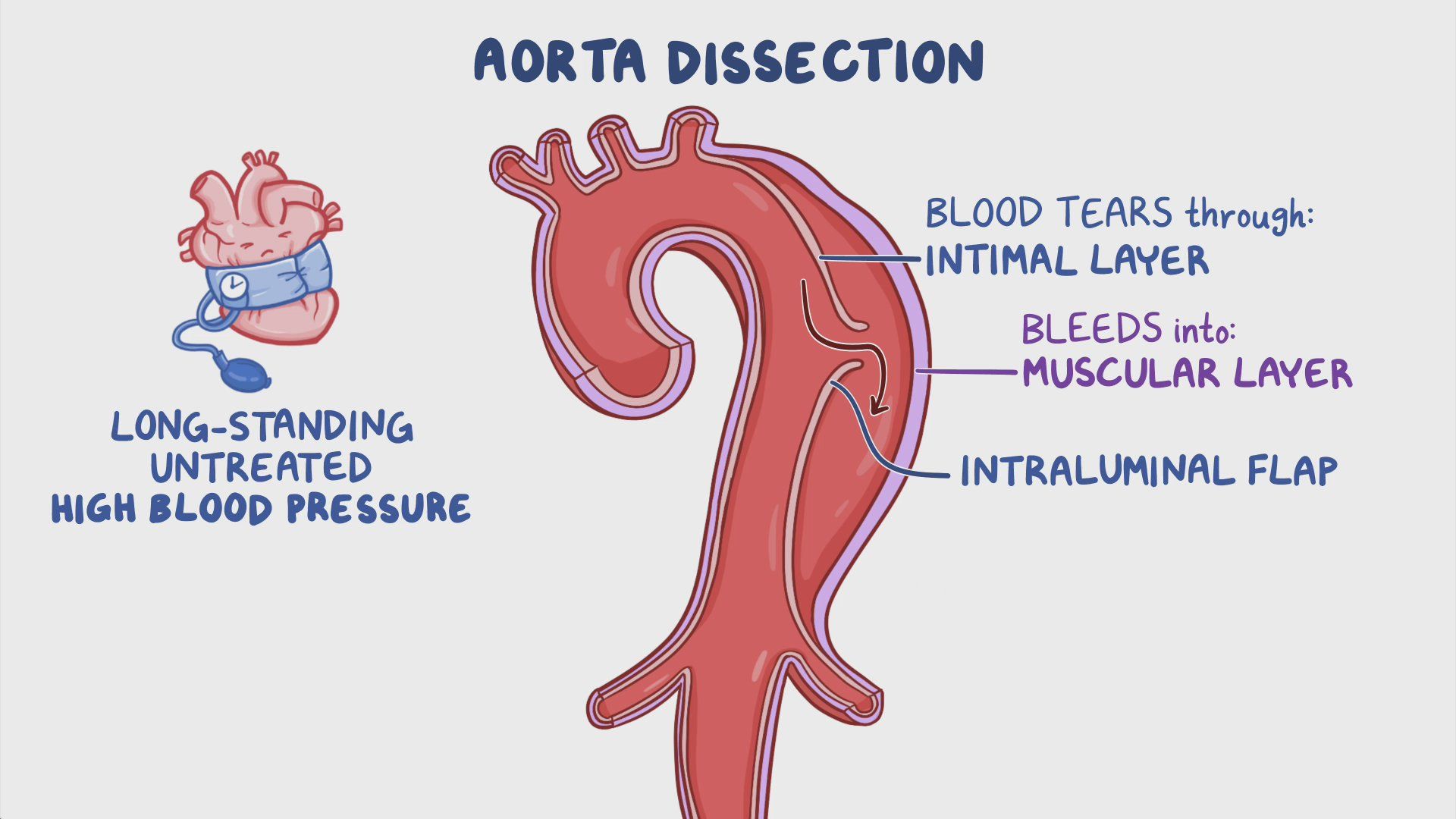Aortic Dissection Osmosis Vrogue co