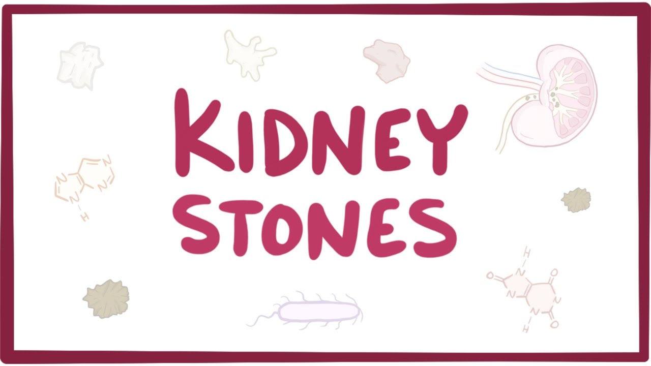 Kidney stones: Video, Anatomy, Definition & Function | Osmosis
