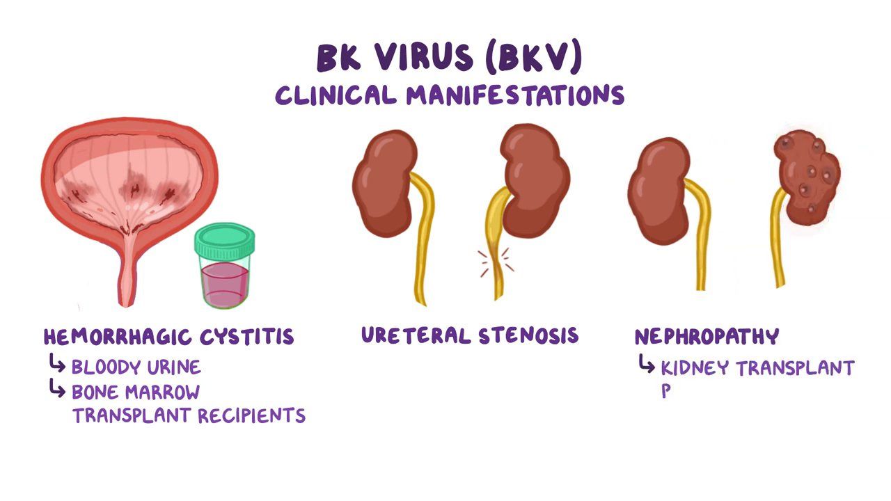 BK Virus Hemorrhagic Cystitis Video Anatomy Osmosis