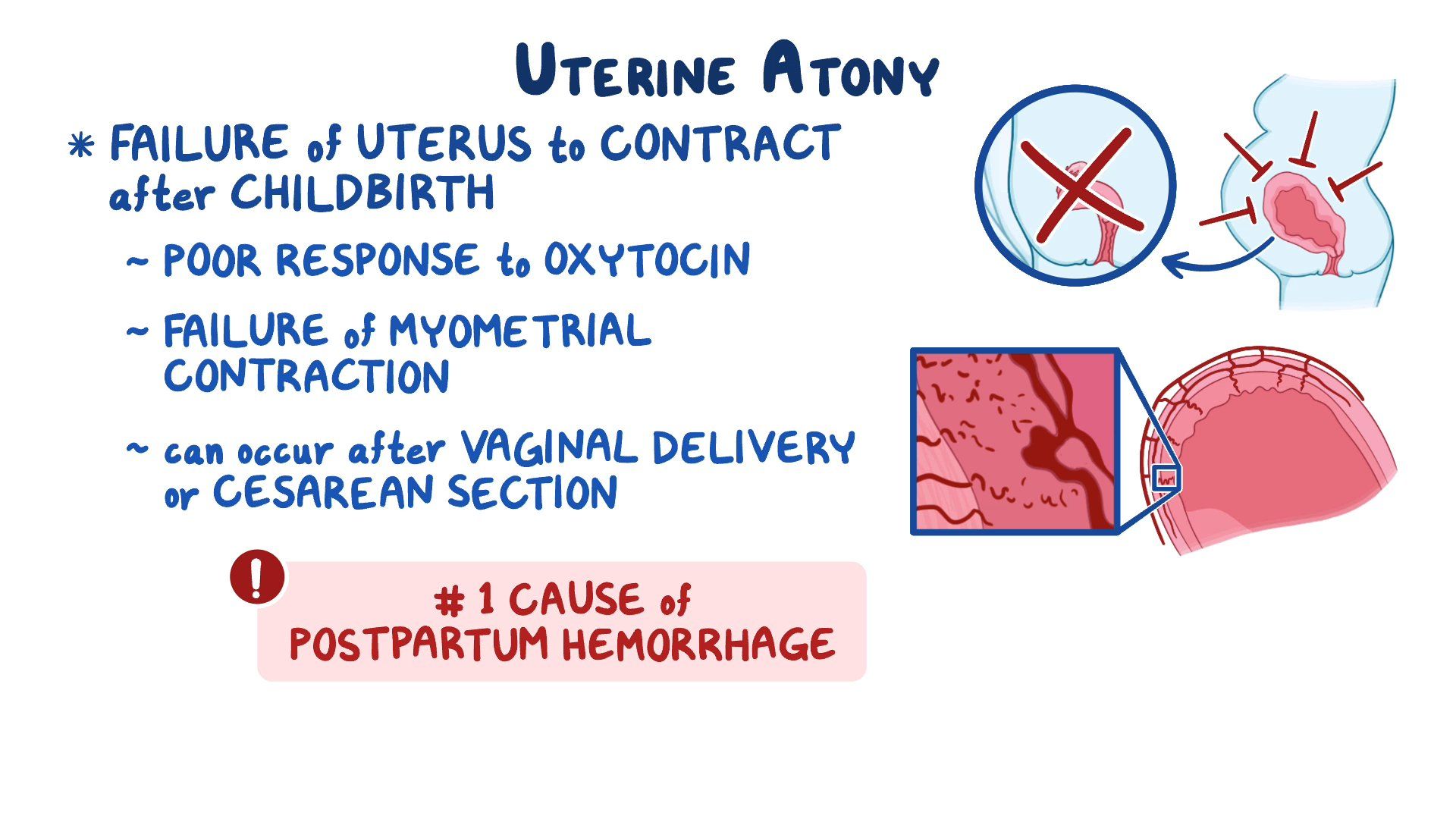Uterine Atony PPT Postpartum Hemorrhage PowerPoint Presentation ID Uterine Atony PPT Postpartum Hemorrhage PowerPoint Presentation ID