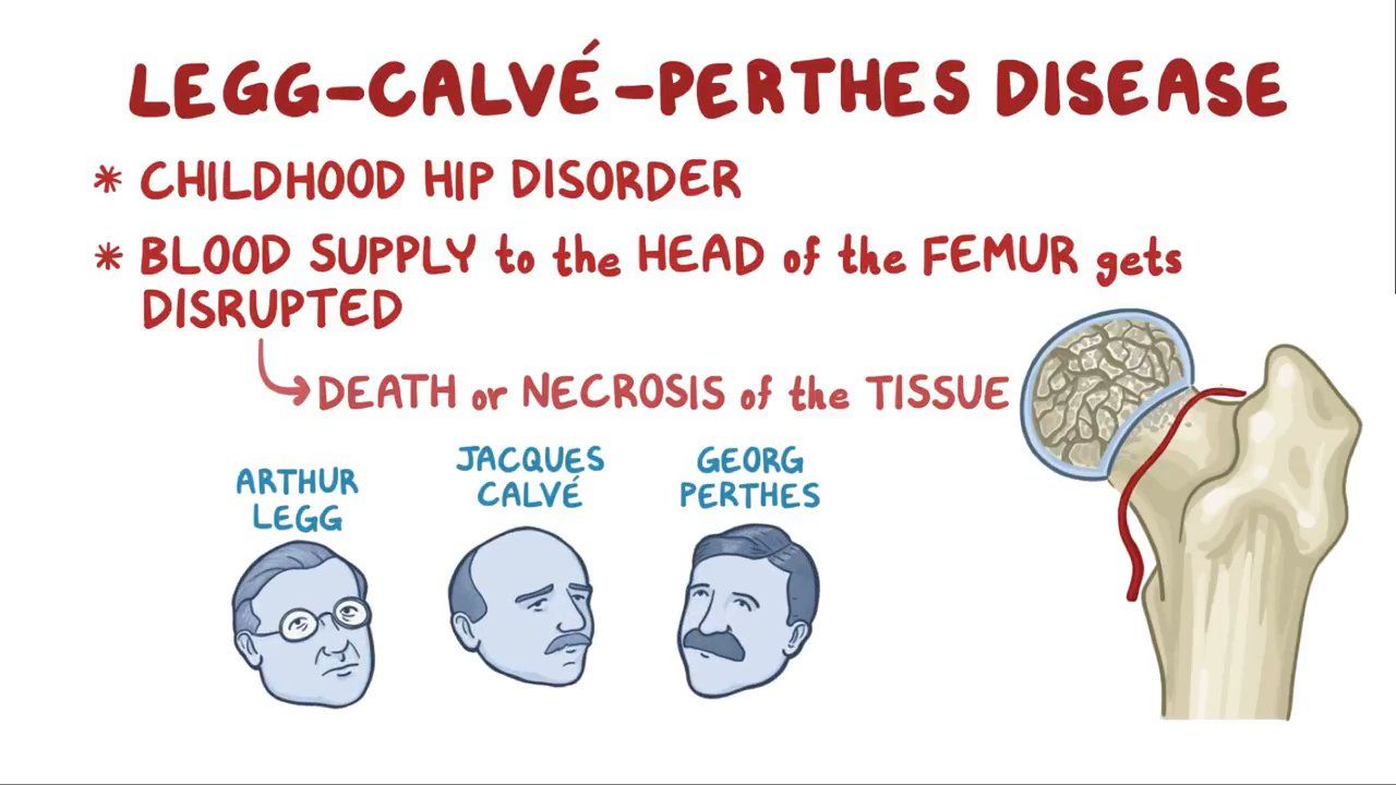 Legg Calve Perthes Disease Video Anatomy Definition Osmosis
