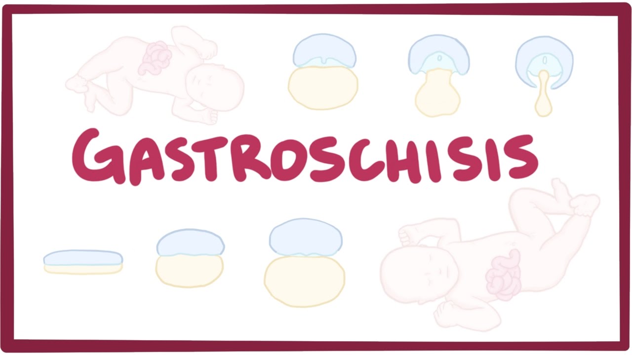 Gastroschisis: Video, Causes, & Meaning | Osmosis