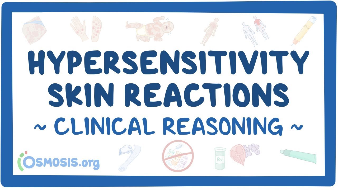 Hypersensitivity skin reactions: Clinical: Video, Causes, & Meaning ...