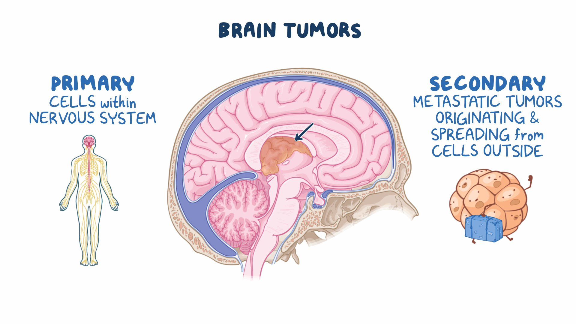 Brain Tumors Nursing Osmosis Video Library Brain Tumors Nursing Osmosis Video Library