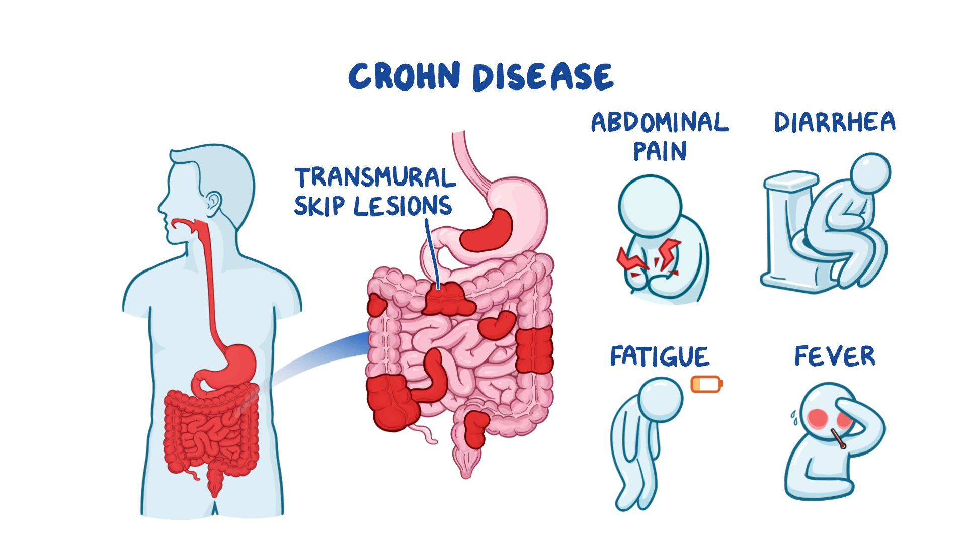 Crohn s Disease Symptoms Causes Complications Prevention 50 OFF