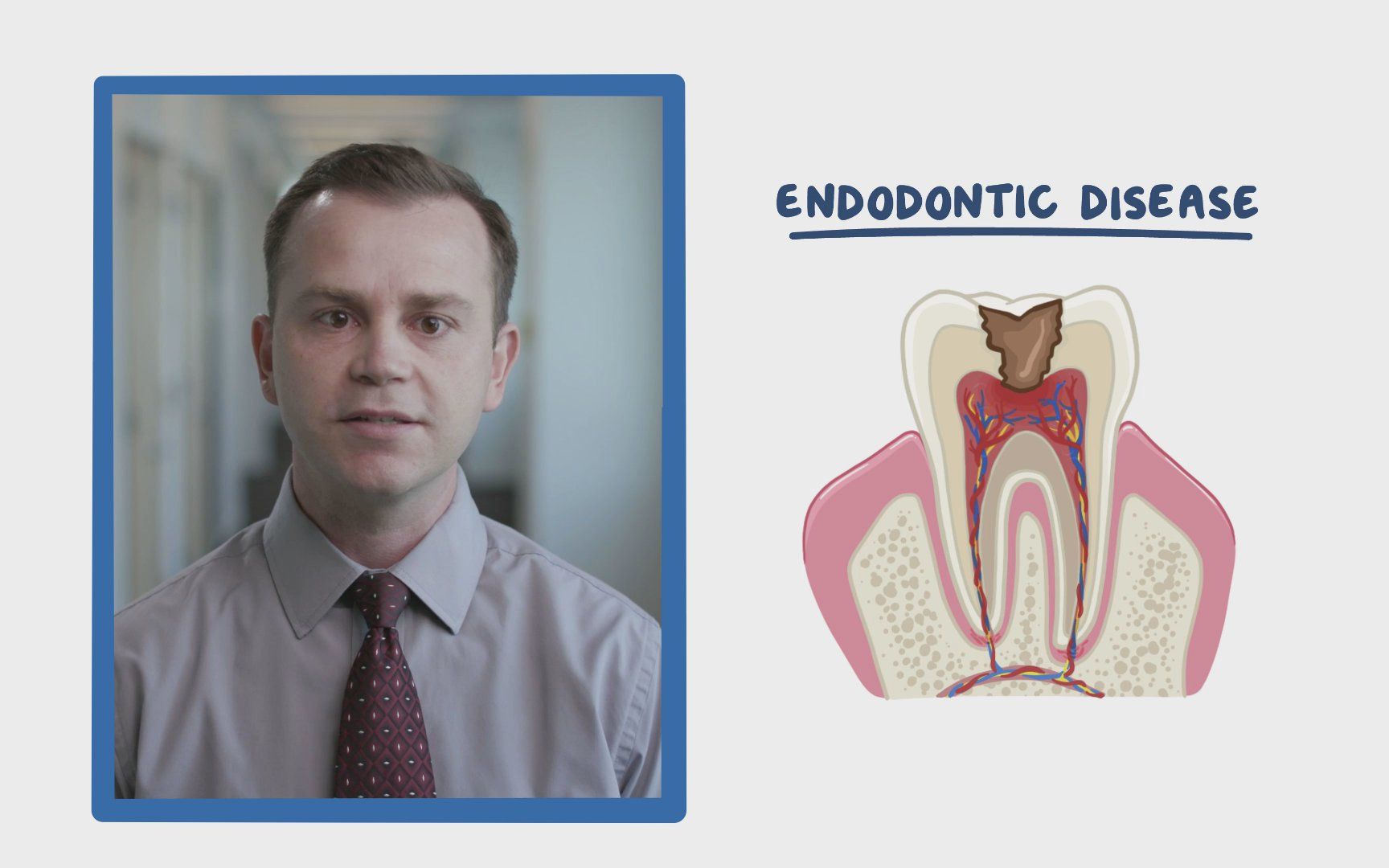 Endodontic disease: Video, Anatomy & Definition | Osmosis